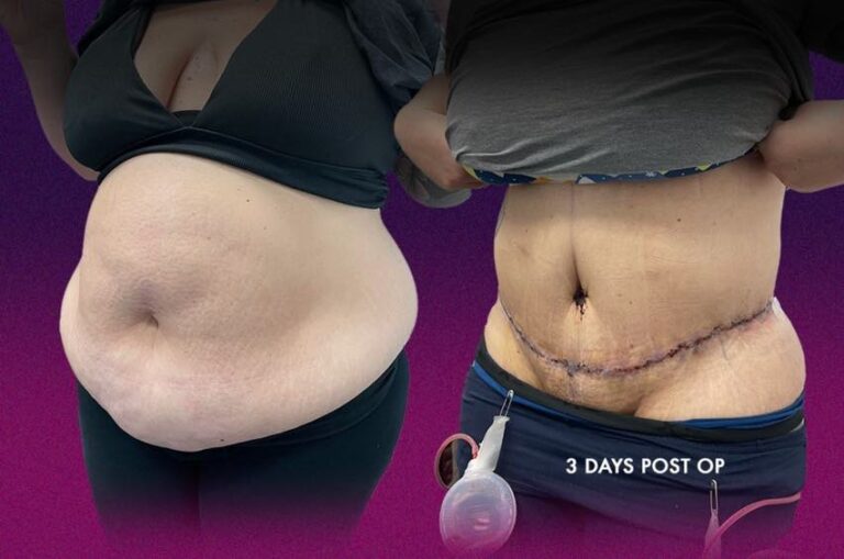 Tummy Tuck Scars Healing And Recovery 2699